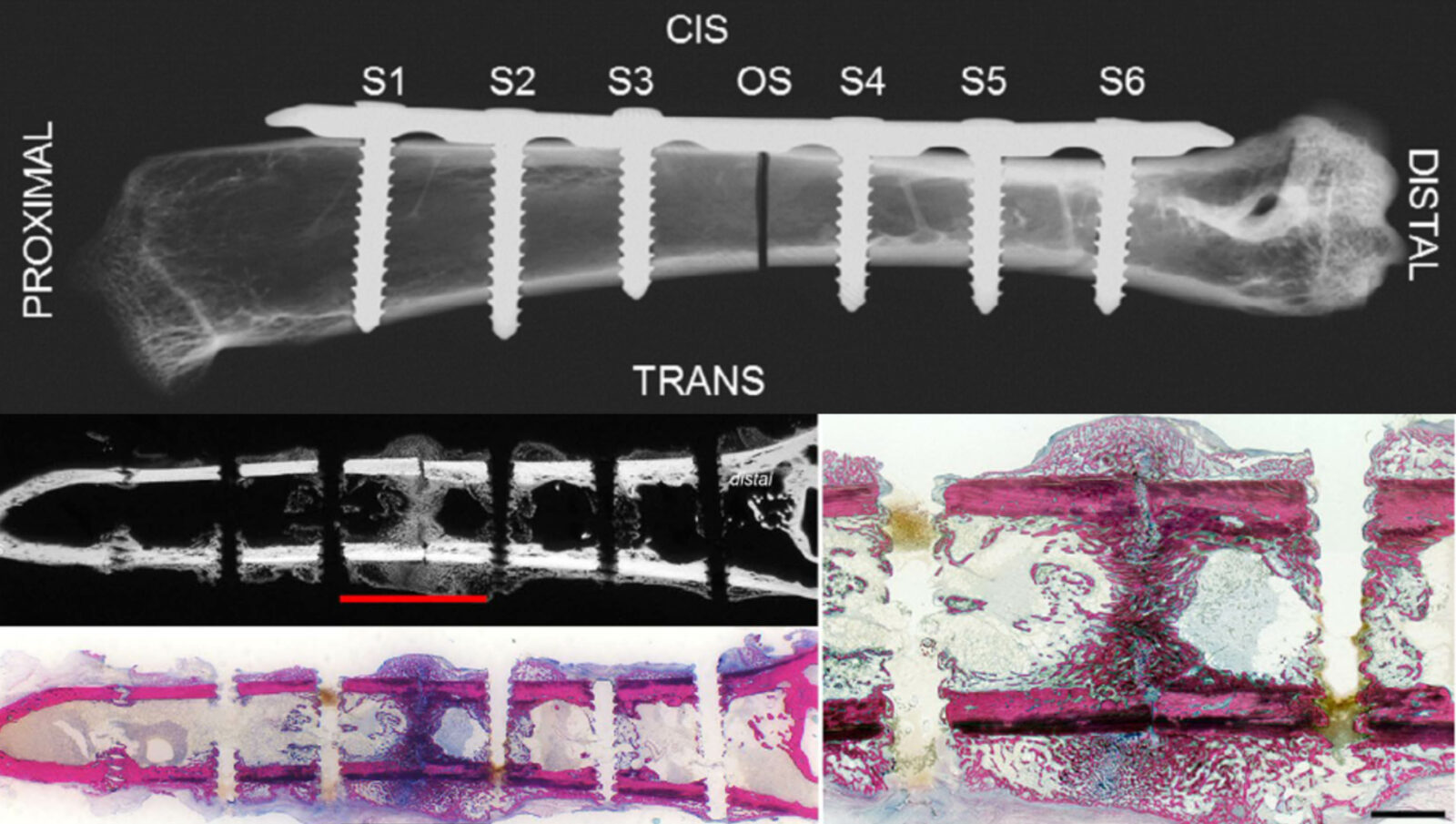 Fighting Bone Infection – Master BME