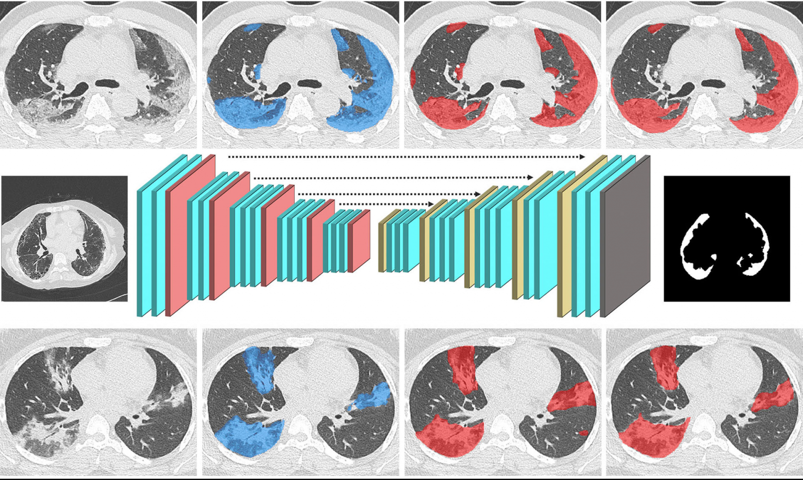 How AI can improve chest imaging of COVID-19? – Master BME